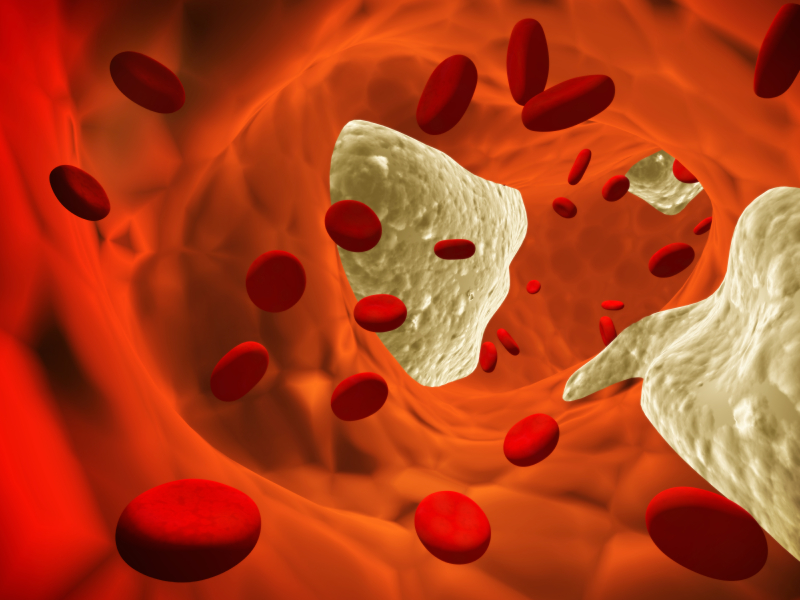 Peripheral Artery Disease - Princeton Surgical Associates